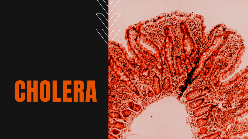 What is Cholera: Causes, Symptoms, Transmission and Treatment